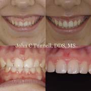 Periodontist Dallas, TX | Central Perio