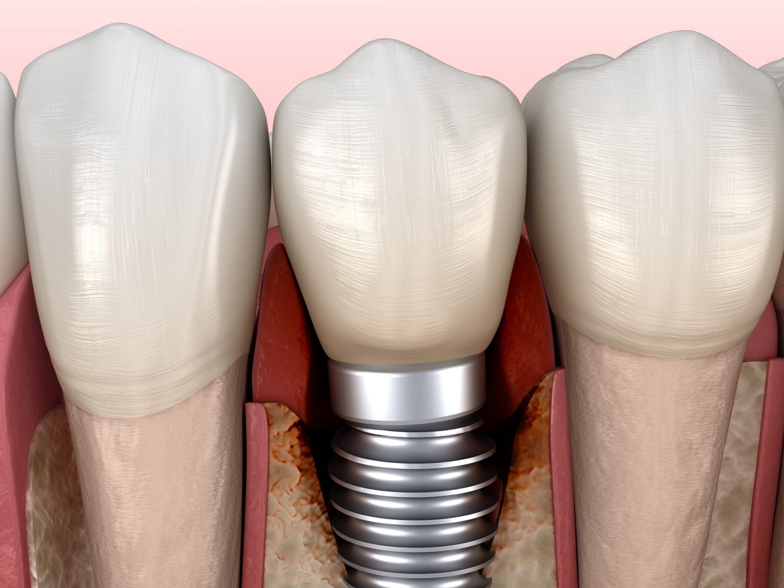 Removing a Failed Dental Implant: What to Expect